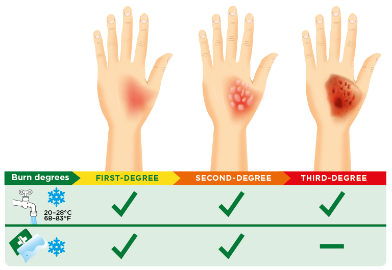 First Aid for Burn Injuries - Global